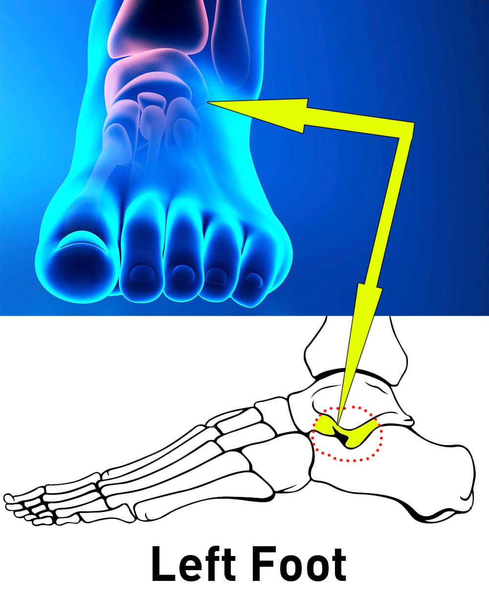 Sprained Ankle... or Snowboarder's Ankle? - Onyx Snowboard School